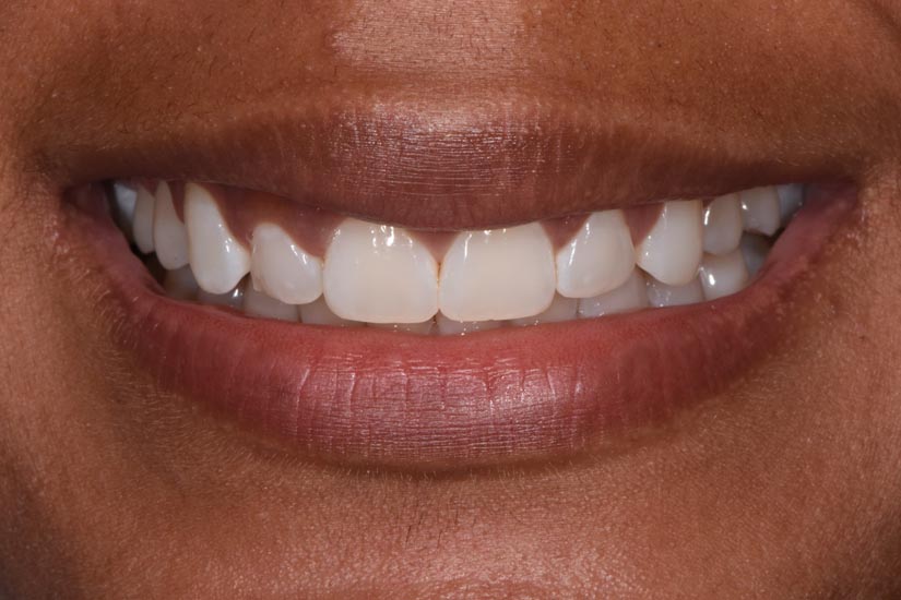 Smile Makeovers - Atlanta Center for Cosmetic Dentistry