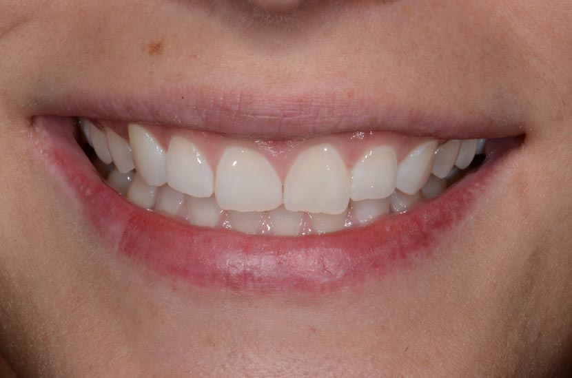 Smile Makeovers - Atlanta Center for Cosmetic Dentistry
